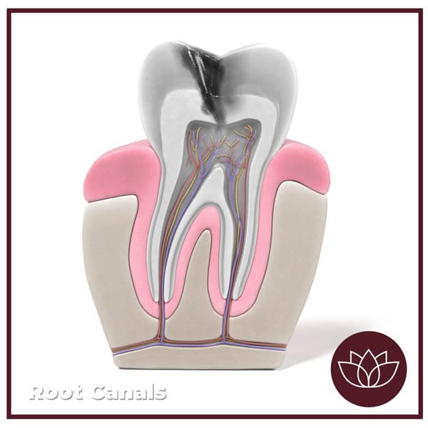Root Canal Treatments | Solihull | Tanworth In Arden | Bellissima Clinic