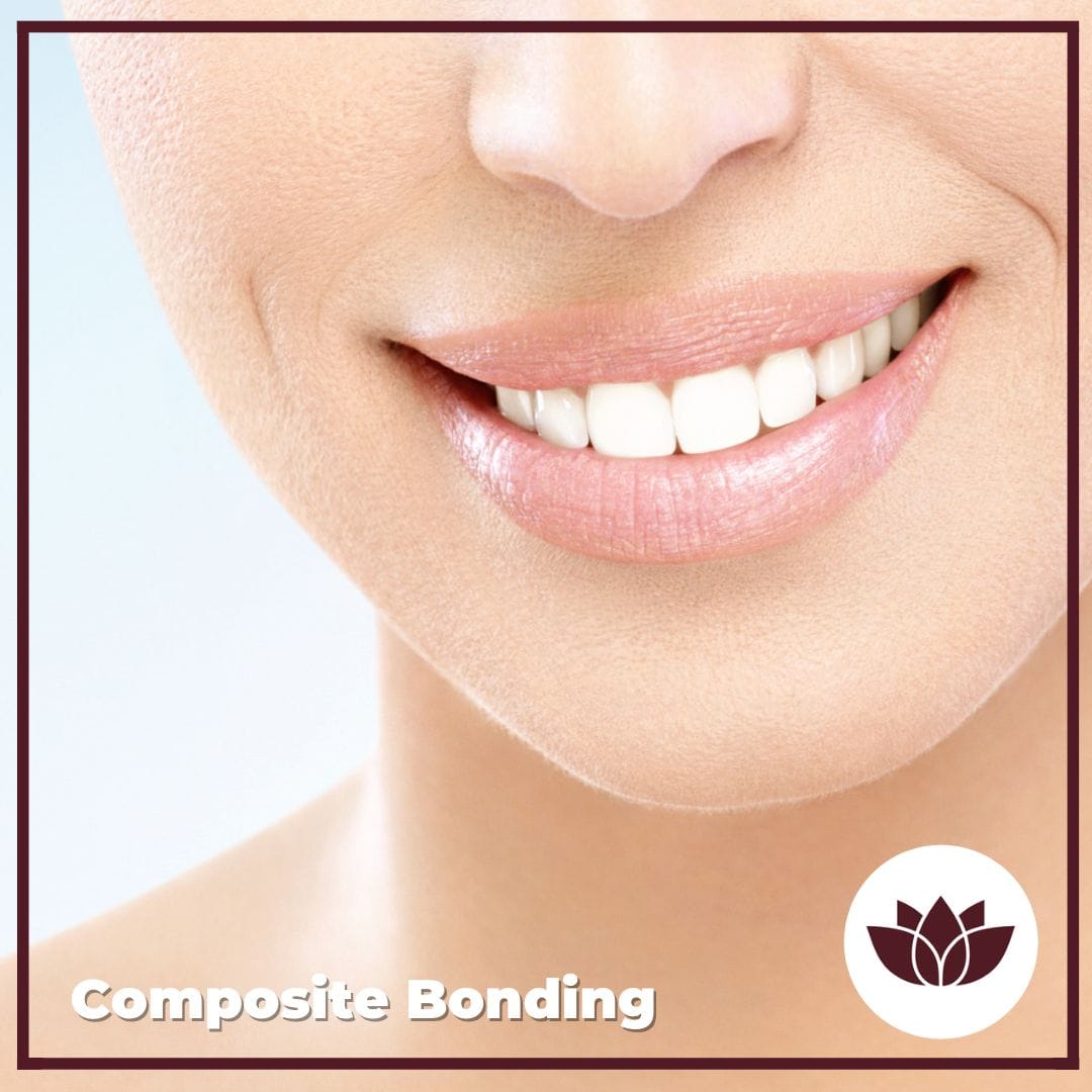 Composite Bonding in Solihull | Redditch | Tanworth-in-Arden ...