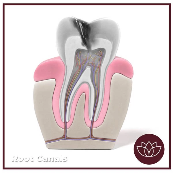 Root Canal Treatments | Solihull | Tanworth In Arden | Bellissima Clinic