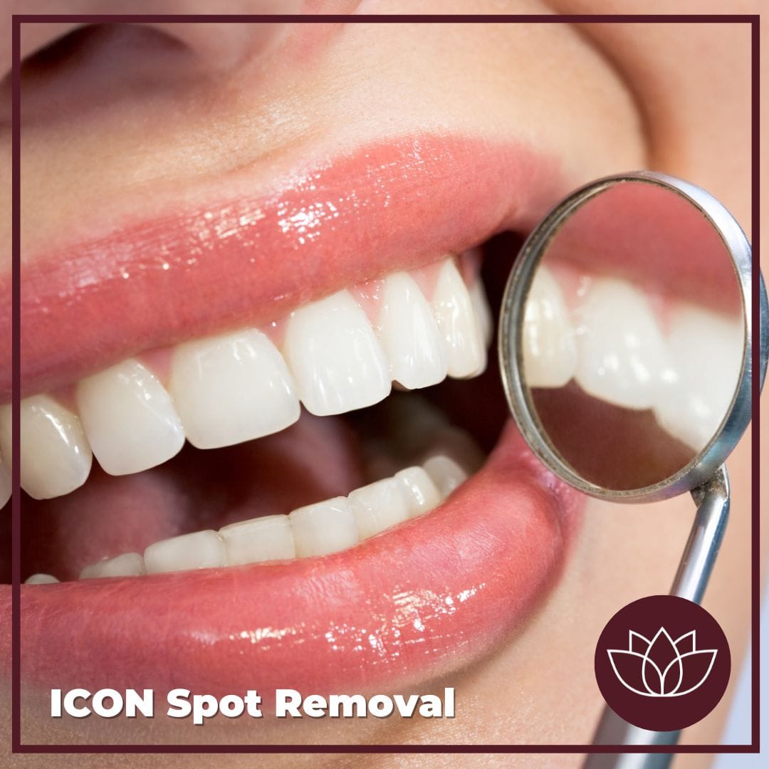 ICON White Spot Removal Solihull & Redditch | Bellissima Clinic